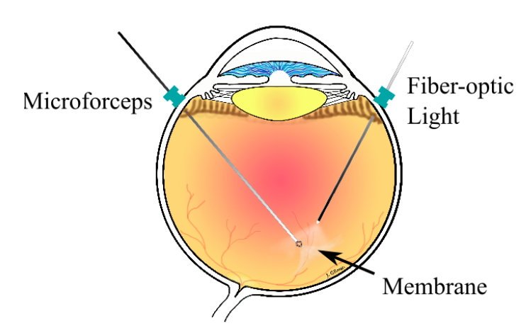 Characterization of Patient Head Motion in Vitreoretinal Surgery ...